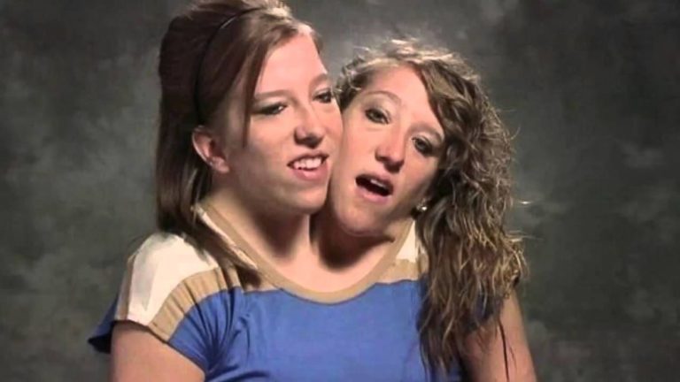 Conjoined Twins Abby and Brittany Hensel: Where are they Now?